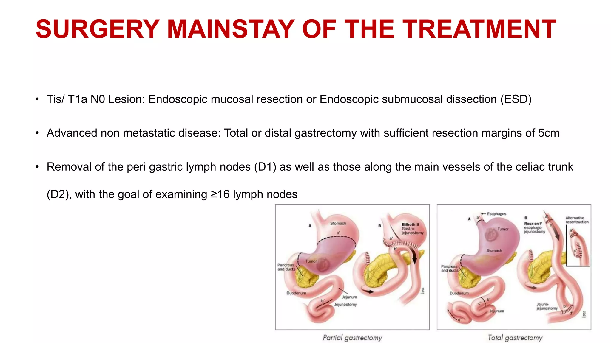 Gastric Cancer Evidence Based Management | PPTX