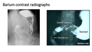 Malignancy of the stomach and other stomach dysplasia.pptx