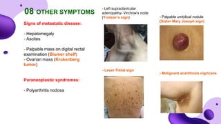 Gastric Cancer | PPT