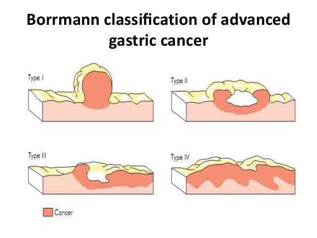 Gastric cancer final
