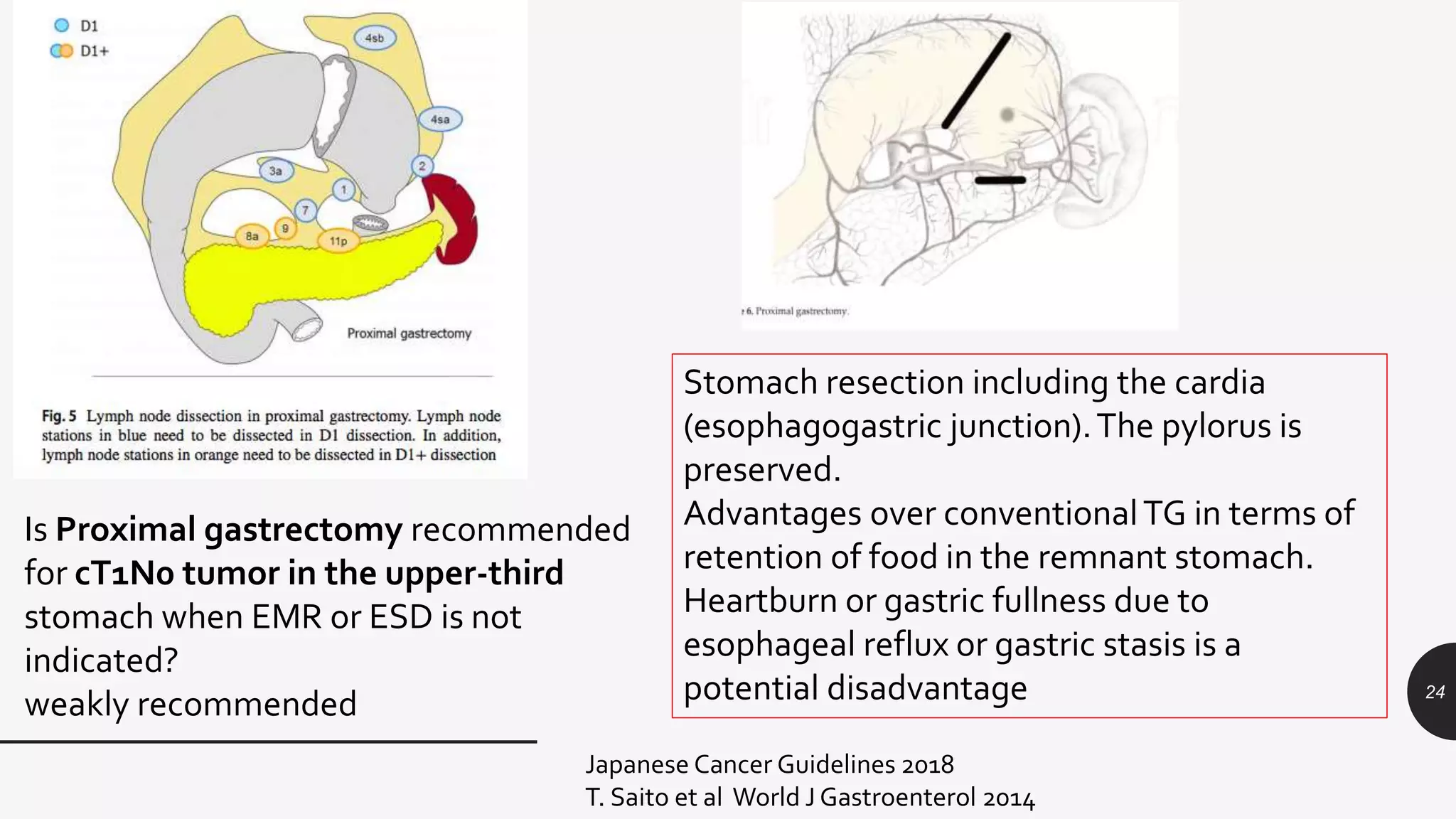 surgical management of gastric cancer | PPTX