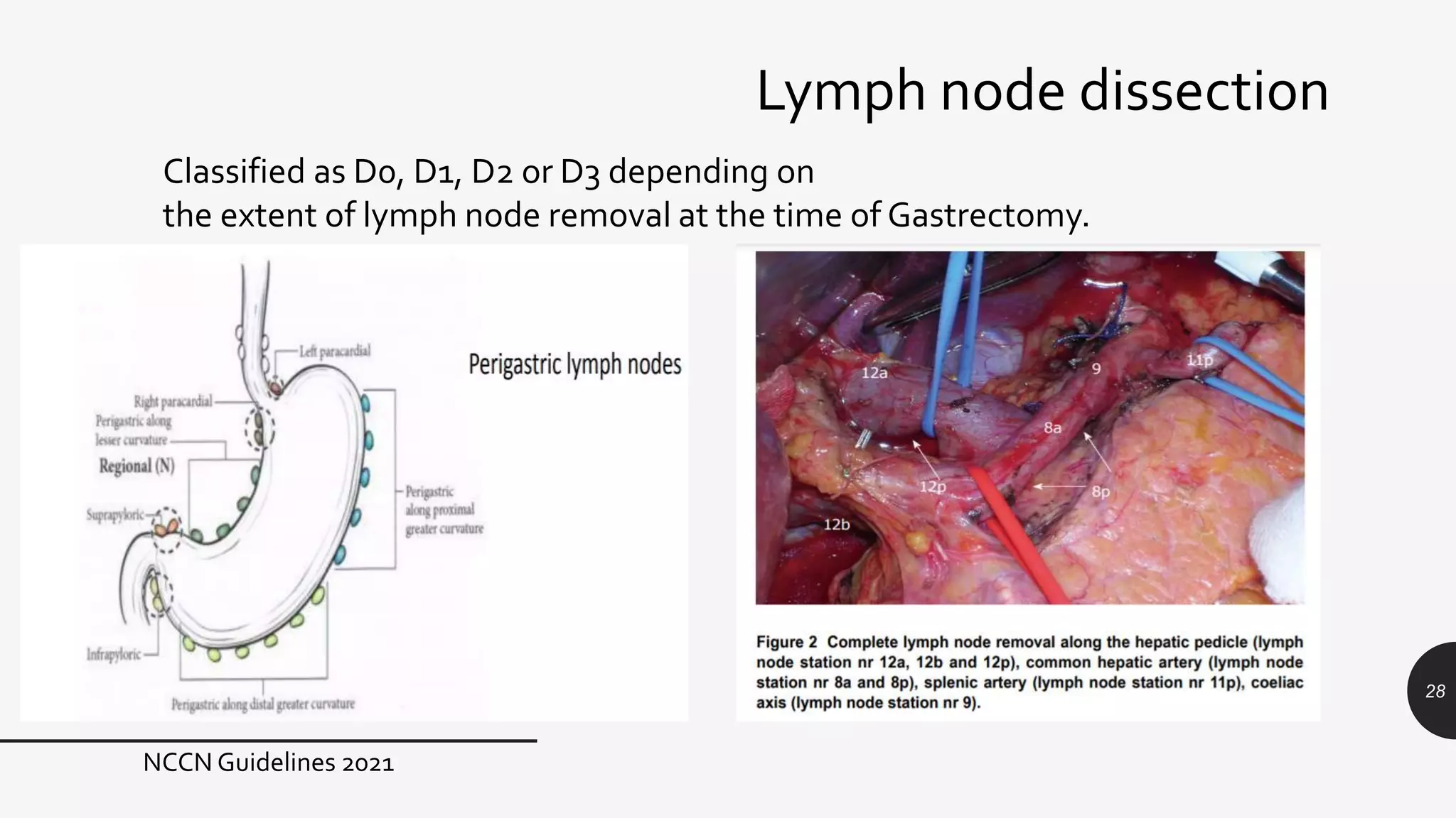 surgical management of gastric cancer | PPTX