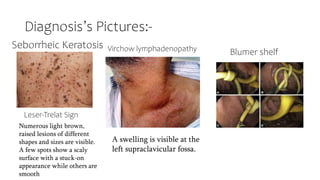 Gastric Cancer Final.pptx