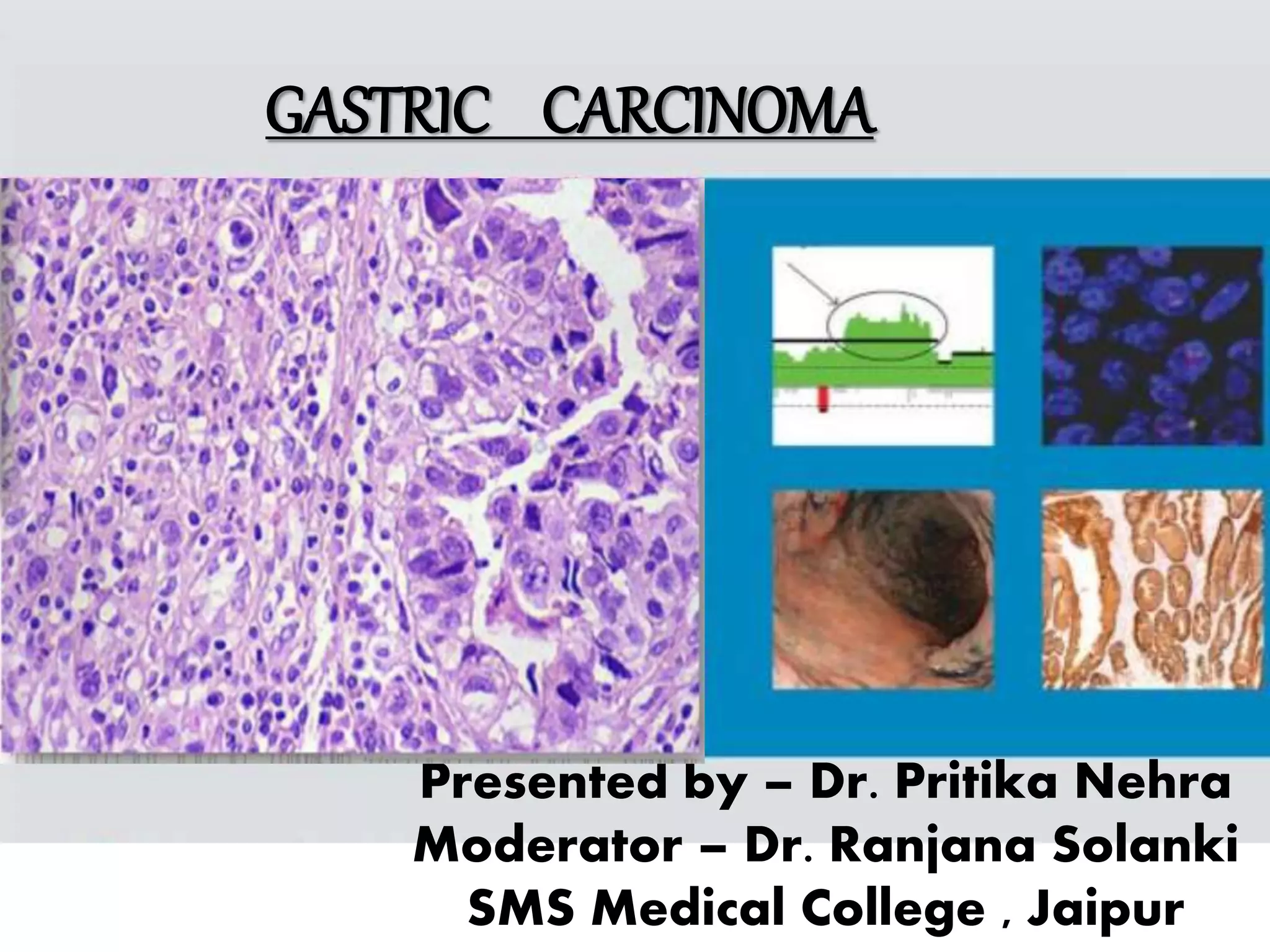 Gastric Cancer - Pathology Seminar | PPTX