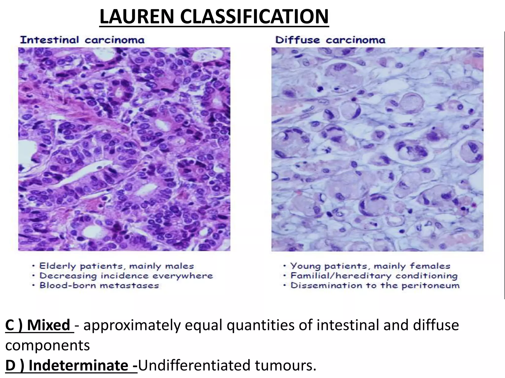 Gastric Cancer - Pathology Seminar | PPTX
