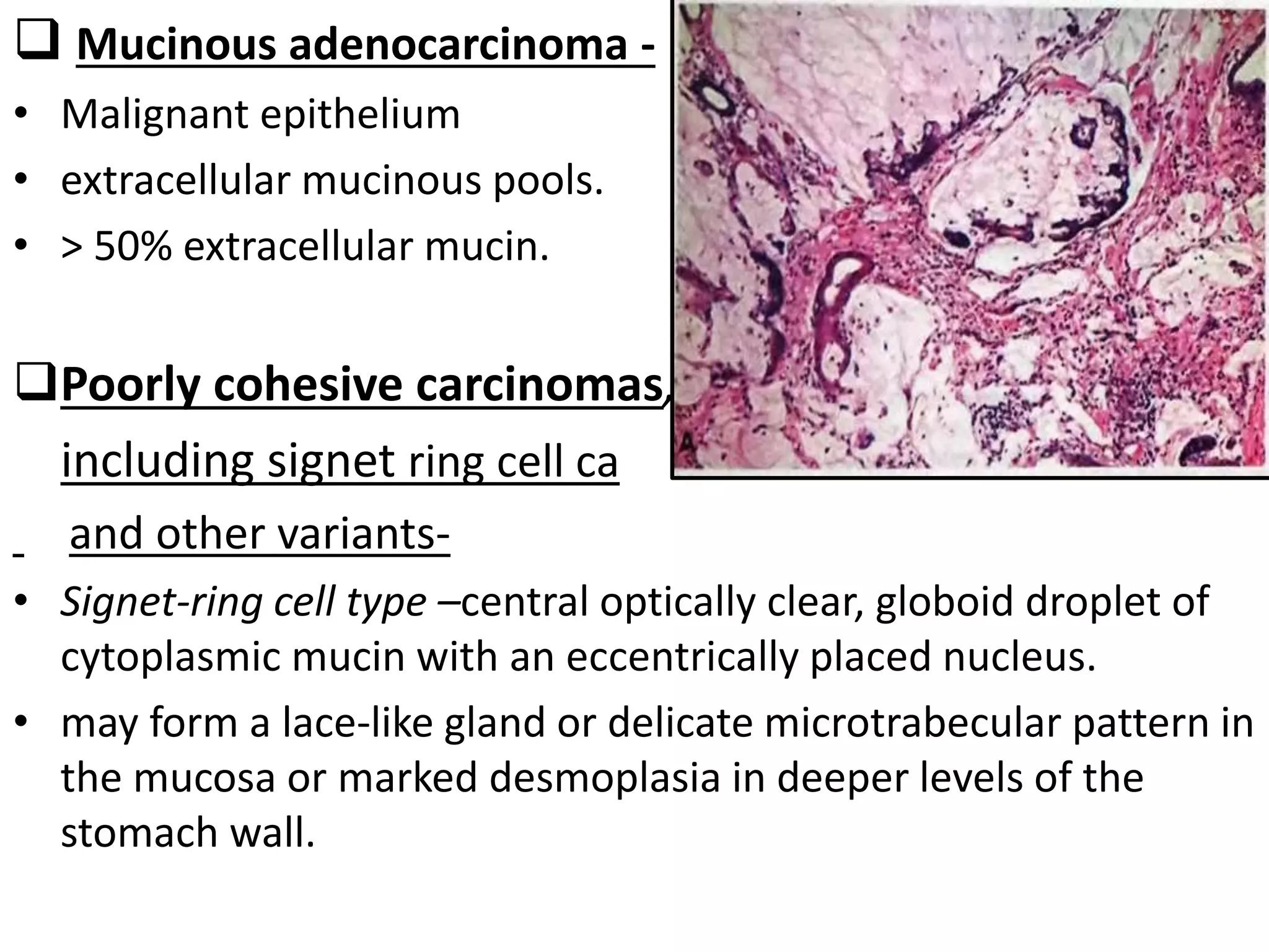 Gastric Cancer - Pathology Seminar | PPTX