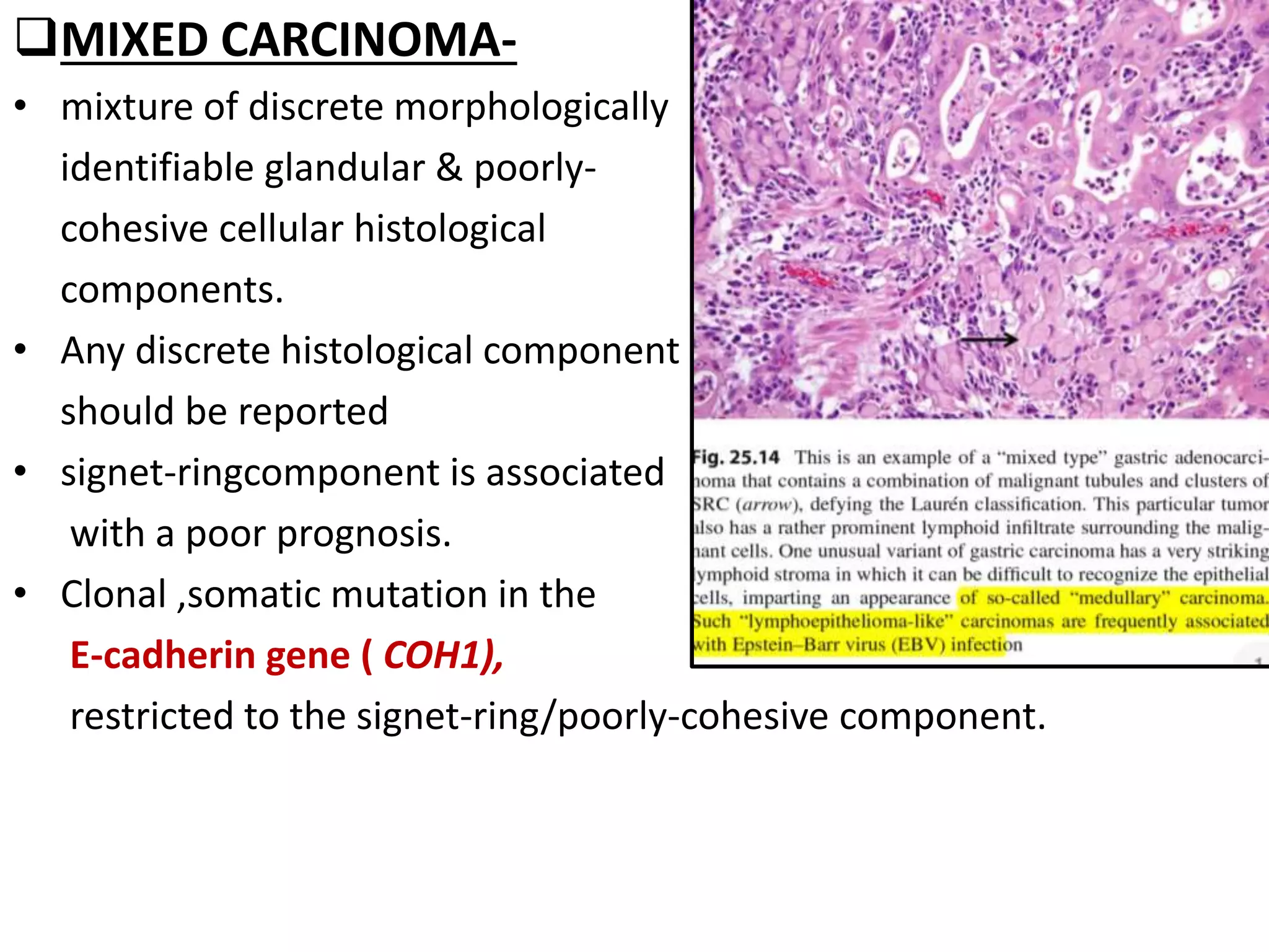 Gastric Cancer - Pathology Seminar | PPTX