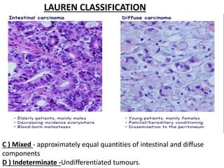 Gastric Cancer - Pathology Seminar | PPTX