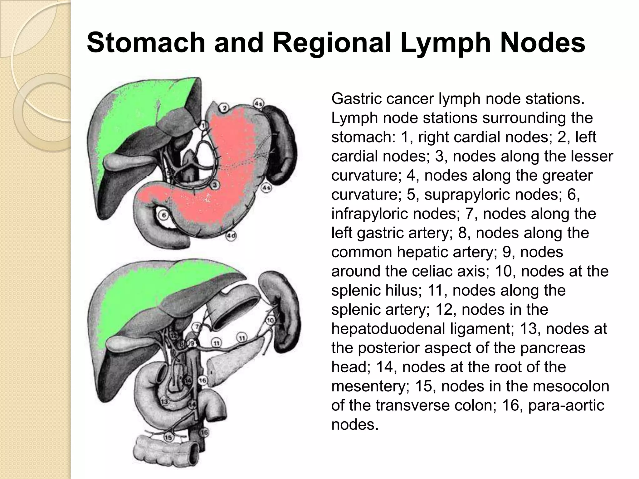 Radiation for Gastric Cancer | PPTX