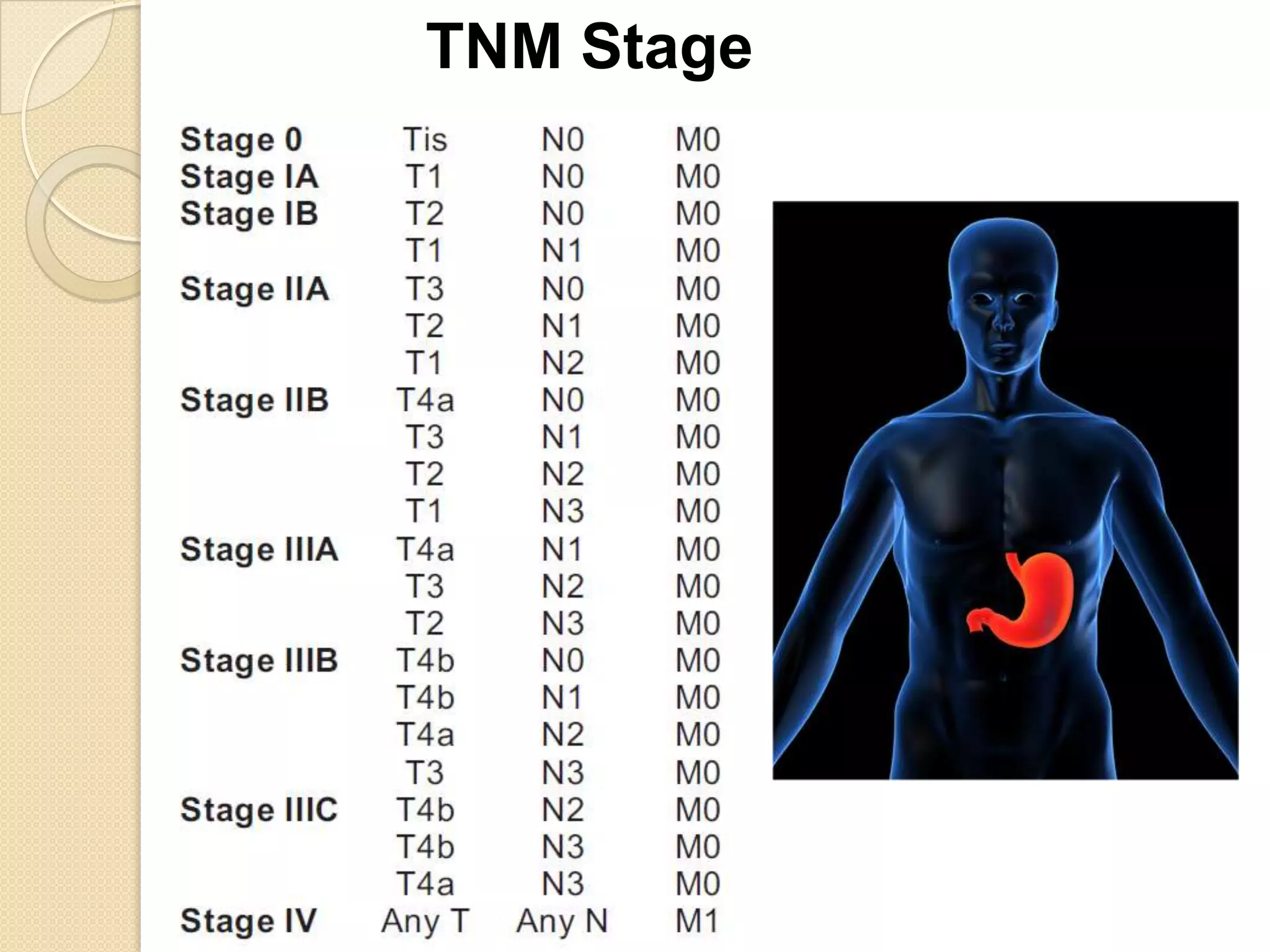 Radiation for Gastric Cancer | PPTX