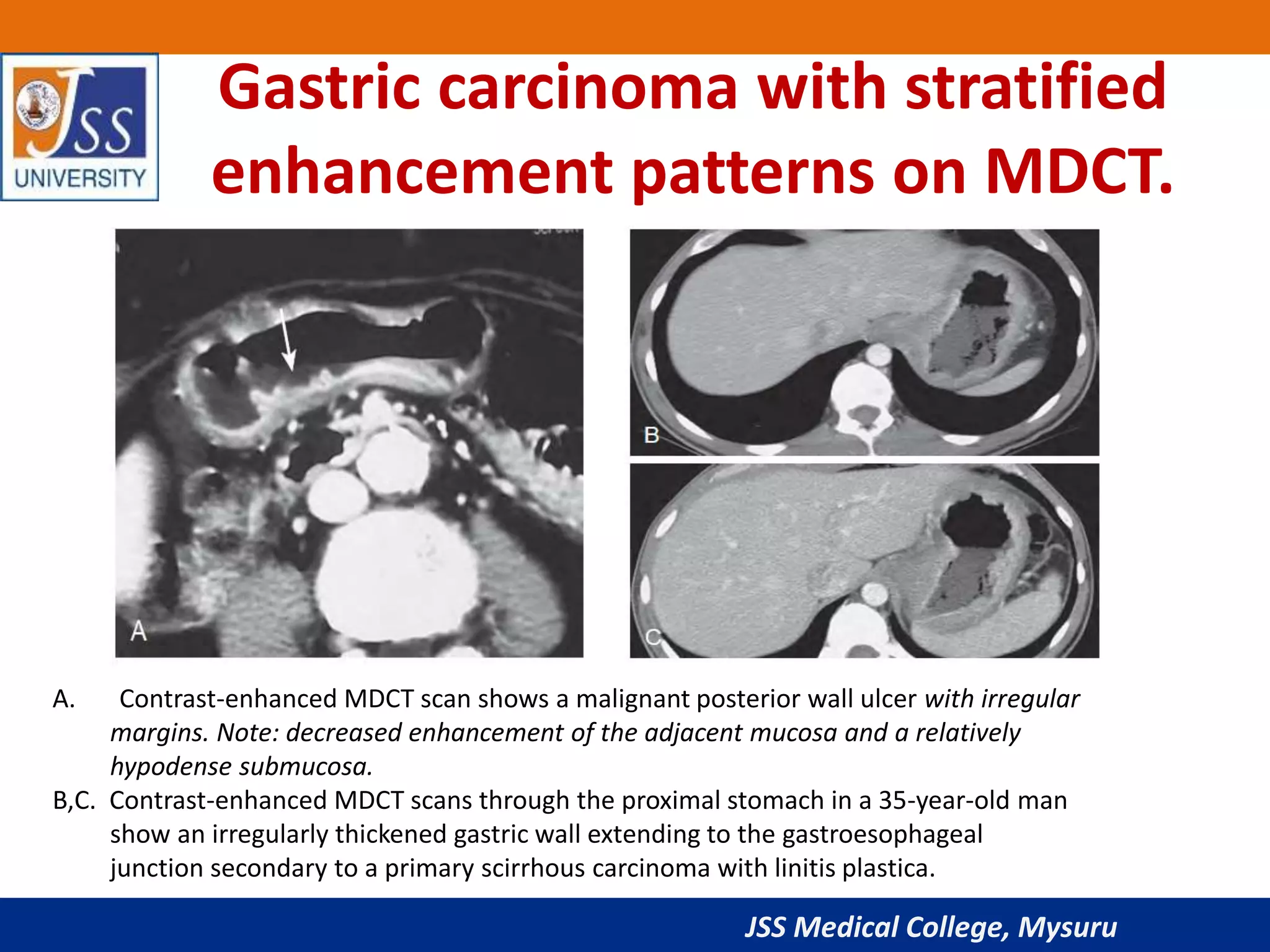 Gastric carcinoma radiology ppt | PPTX