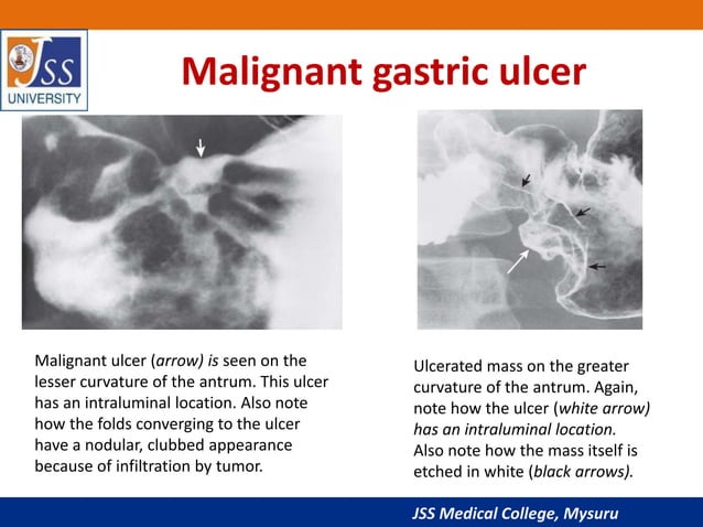Gastric carcinoma radiology ppt | PPT