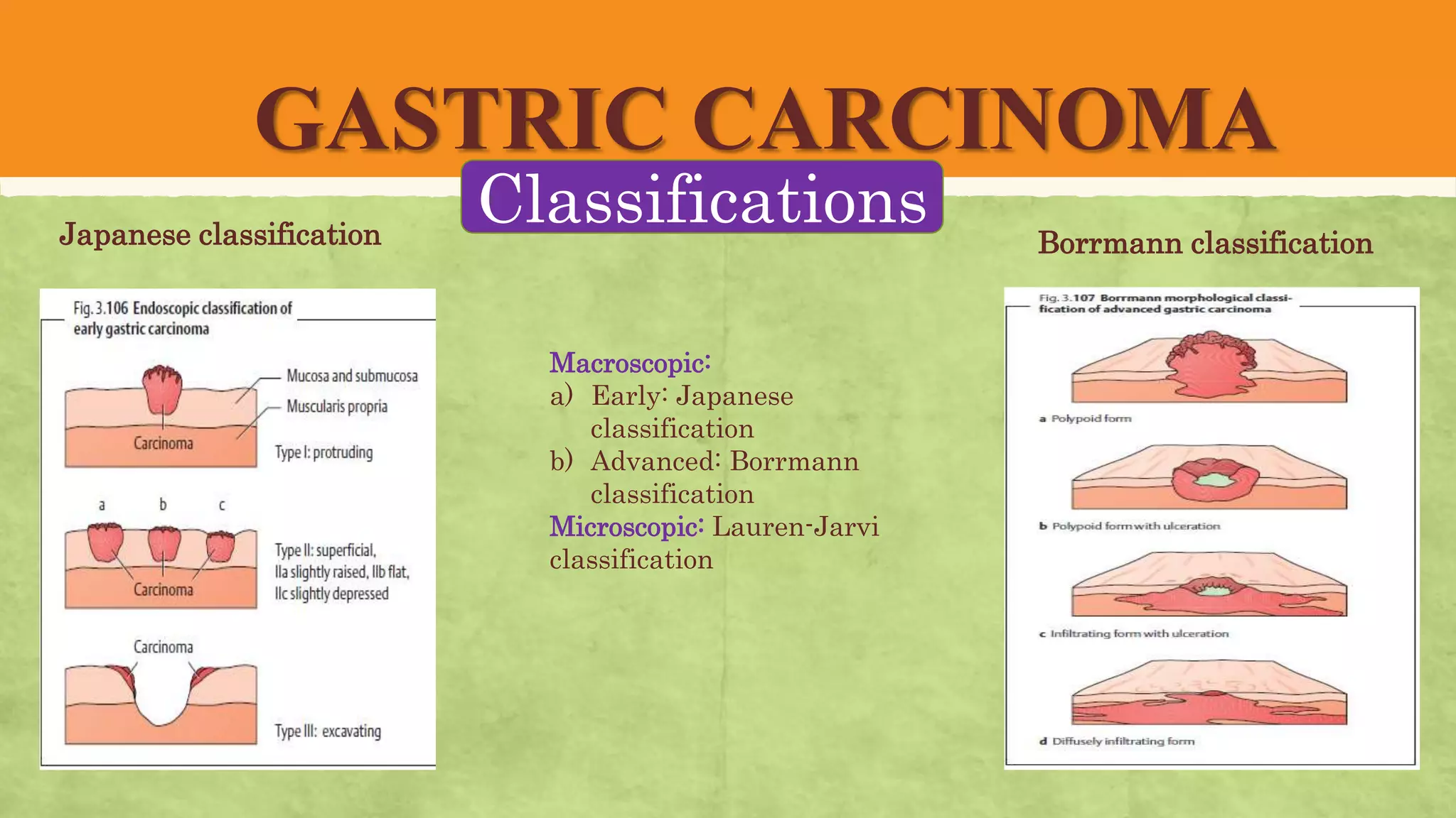 GASTRIC CARCINOMA- EPIGASTRIC LUMPS- Abdominal Lumps.pptx