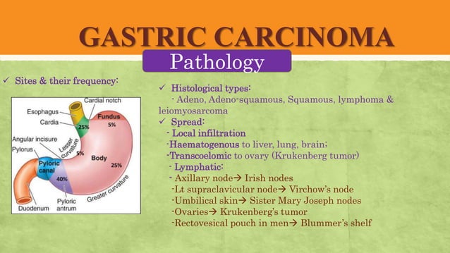 GASTRIC CARCINOMA- EPIGASTRIC LUMPS- Abdominal Lumps.pptx | Cancer ...