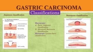 GASTRIC CARCINOMA- EPIGASTRIC LUMPS- Abdominal Lumps.pptx