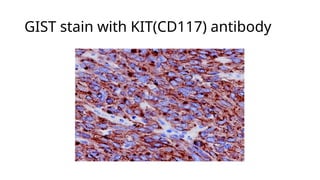 GASTRIC GIST(Gastrointestinal stromal tumors (GISTs) are typically ...