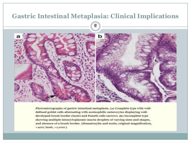 Gastric Intestinal Metaplasia - Clinical Implications