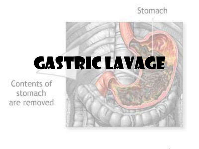 Gastric lavage | PPTX | Lung and Respiratory Health | Diseases and ...