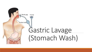 Gastric lavage | PPTX