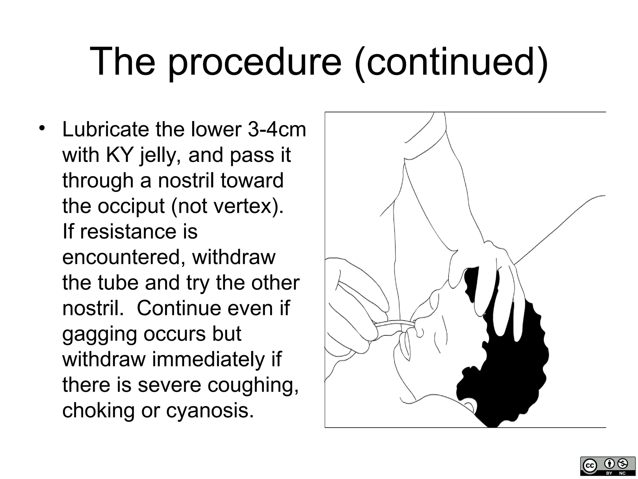 Gastric Lavage: Indications, Techniques, and Complications | PPT