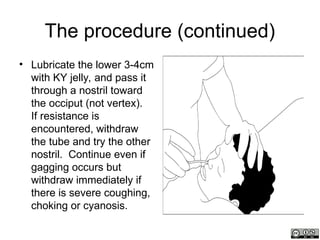 Gastric Lavage: Indications, Techniques, and Complications | PPT