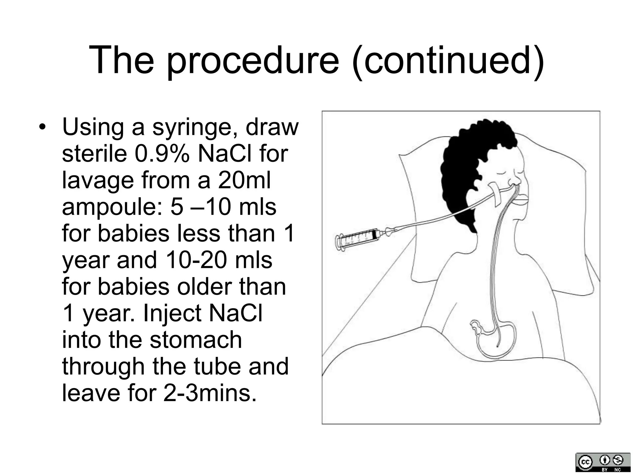 Gastric_LavagePres.ppt