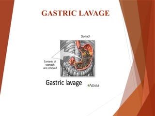 Gastric_Lavage_Presentation in obstetrics and gynaecological nursing | PPTX
