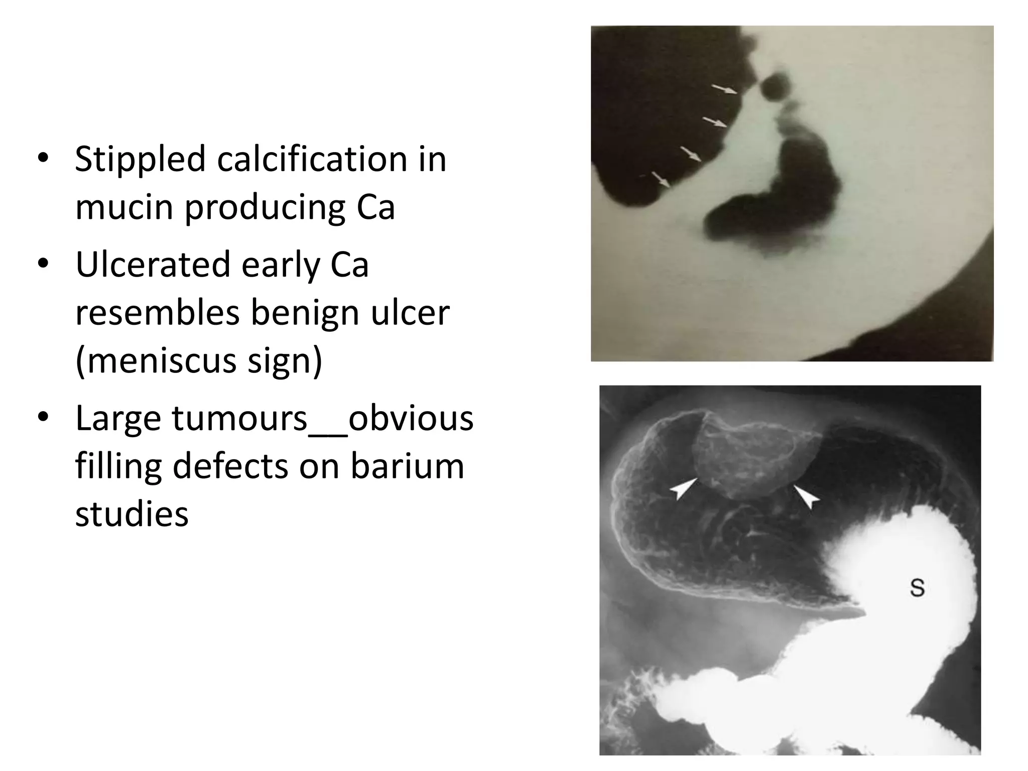 Gastric neoplasm | PPTX