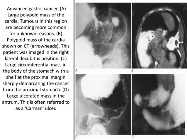 Gastric neoplasm | PPT