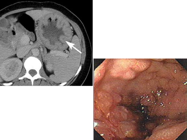 Gastric neoplasm | PPT