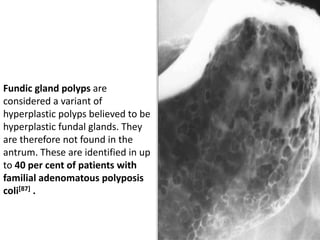 Gastric neoplasm | PPTX