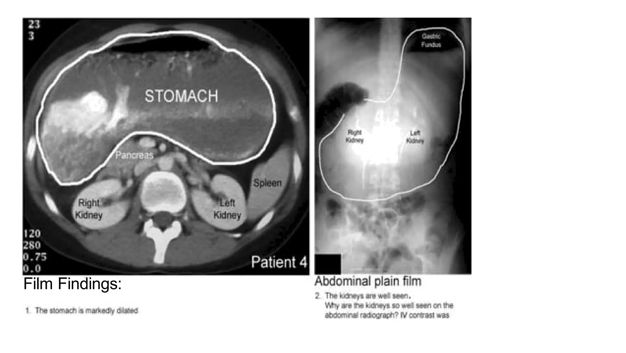 Gastric outlet obst and anatomy of stomach . PPT.pptx