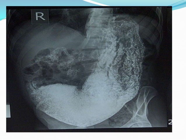 Gastric outlet obstruction | PPTX