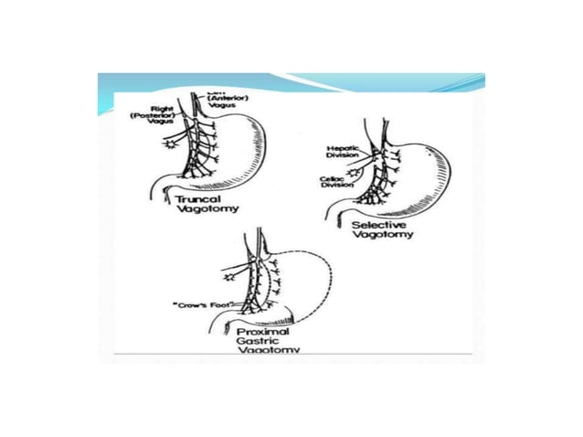 Gastric outlet obstruction | PPTX