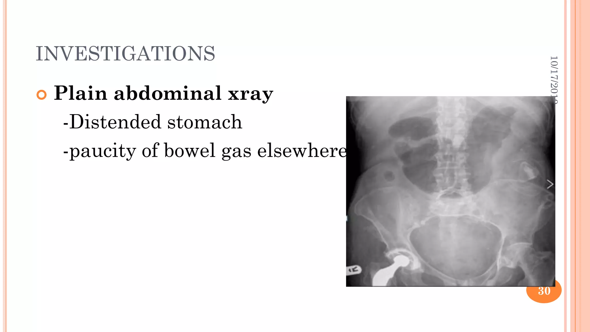 Gastric outlet obstruction | PDF