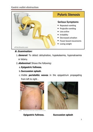 Gastric outlet Obstructionnnnnnn n (1).pdf