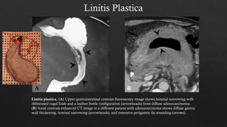 gastric pathology and how they present radiologically | PPTX