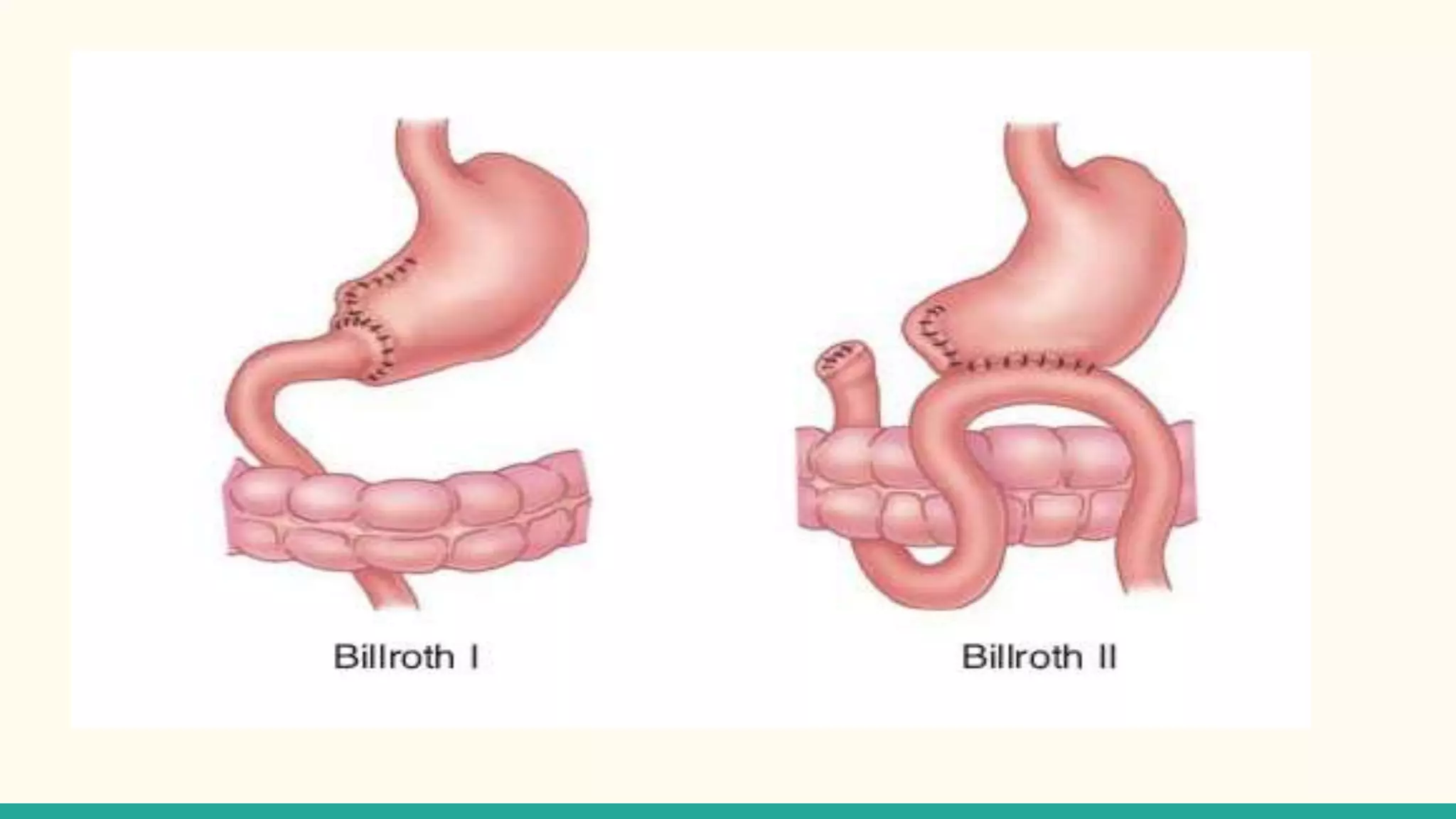 Gastric Perforation From Peptic Ulcer Disease - A Review of the ...