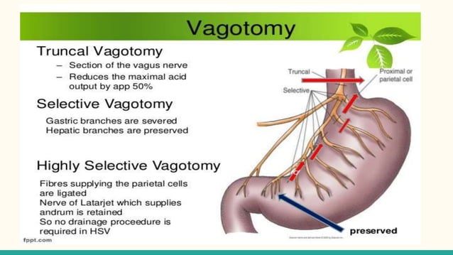 Gastric Perforation From Peptic Ulcer Disease - A Review of the ...