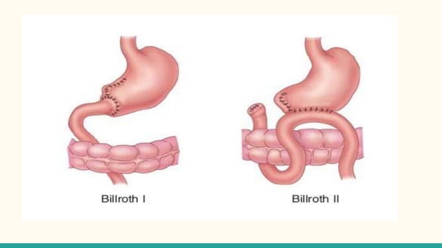 Gastric Perforation From Peptic Ulcer Disease - A Review of the ...