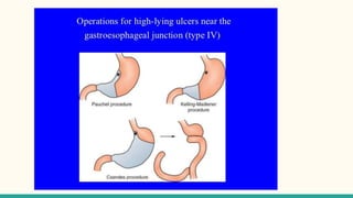 Gastric Perforation From Peptic Ulcer Disease - A Review of the ...