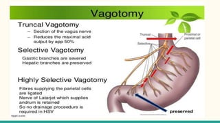 Vagotomy And Antrectomy
