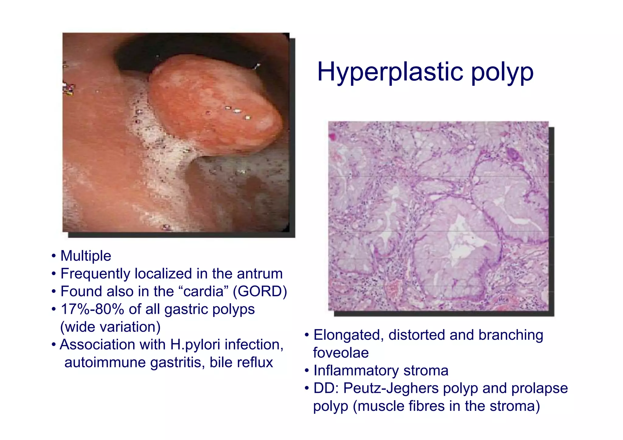 Gastric polyps | PPTX
