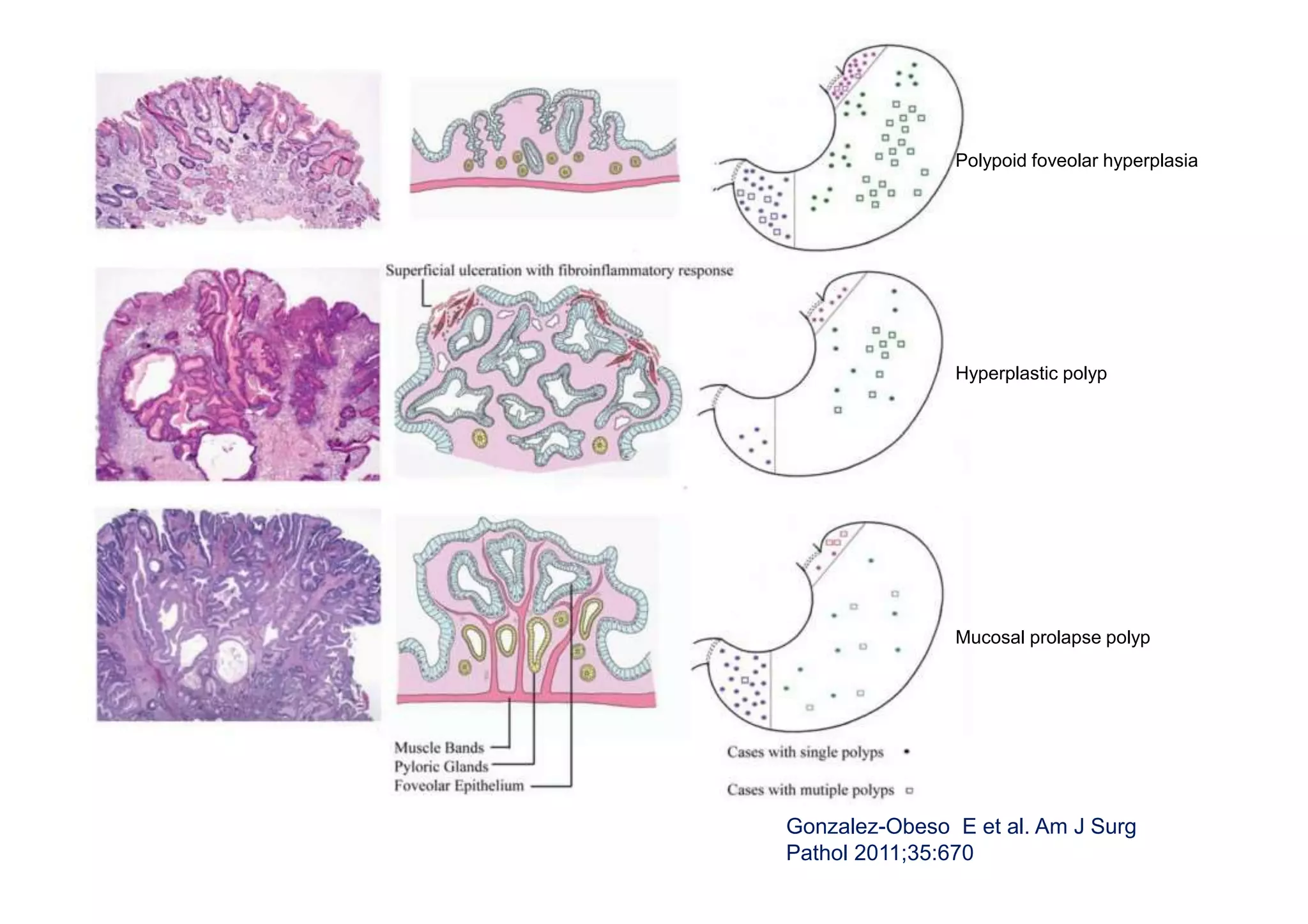 Gastric polyps | PPTX