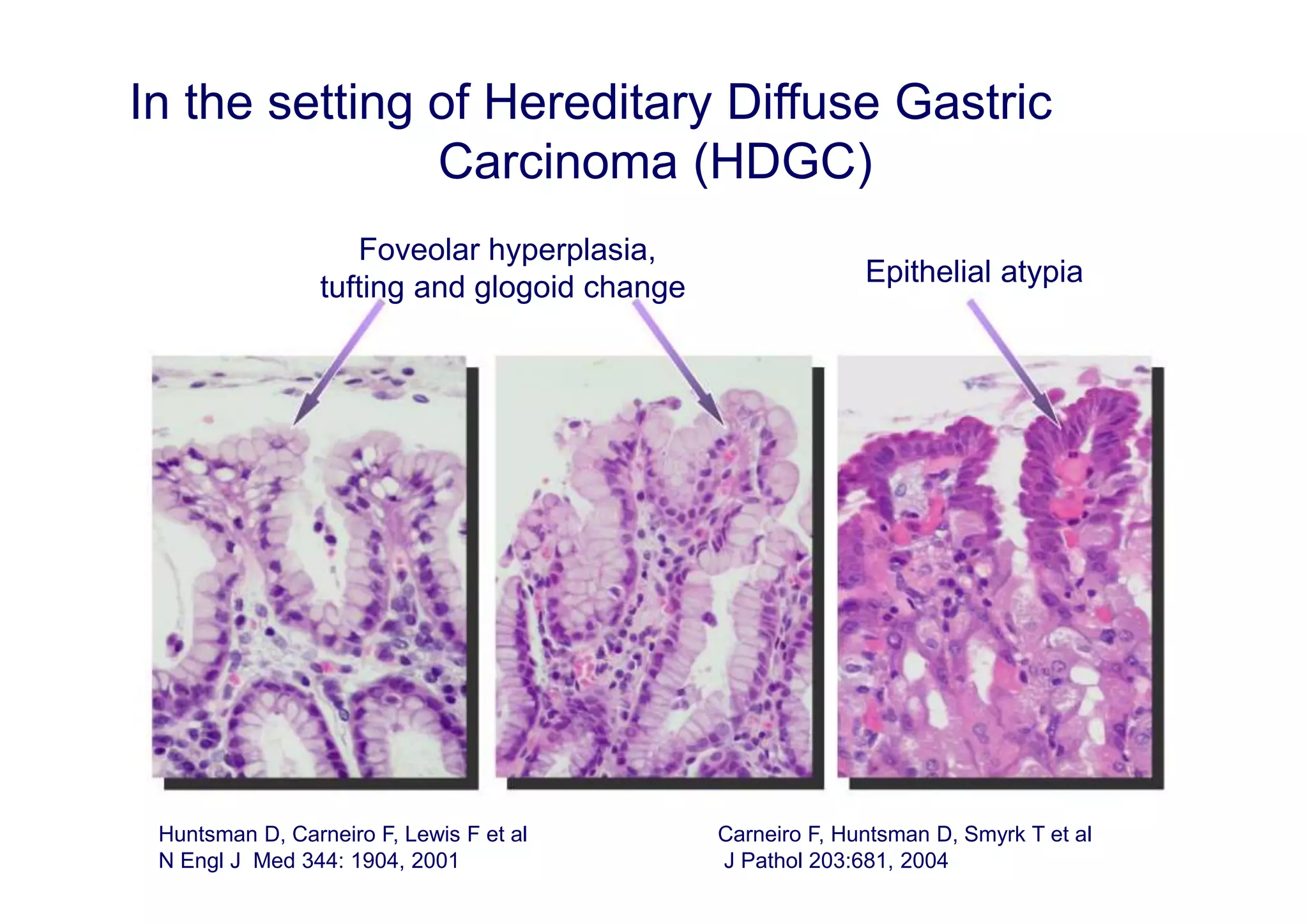 Gastric polyps | PPTX