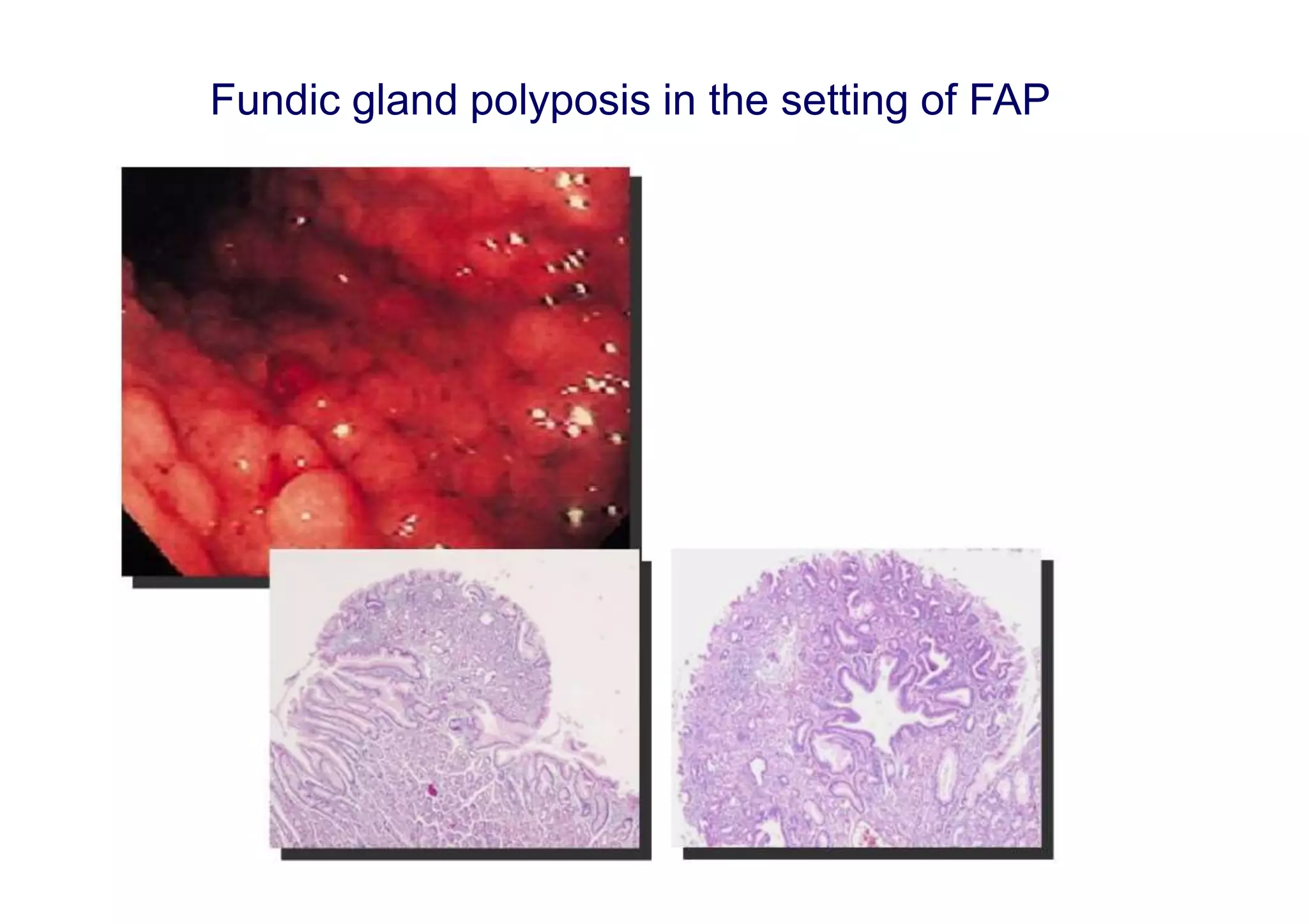 Gastric polyps | PPTX