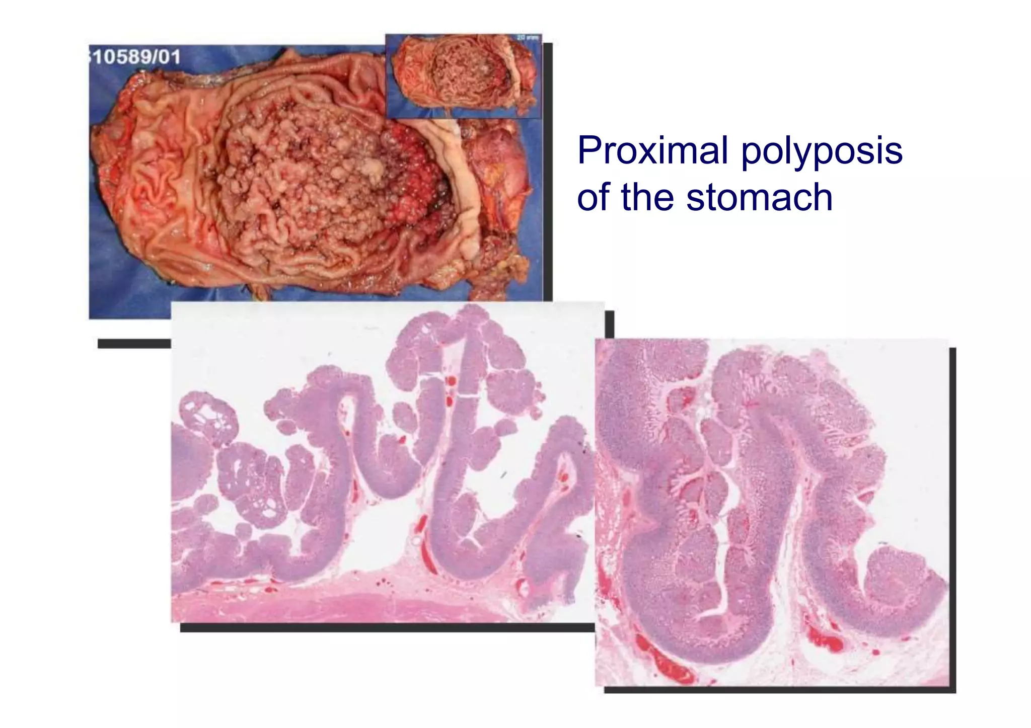 Gastric polyps | PPTX