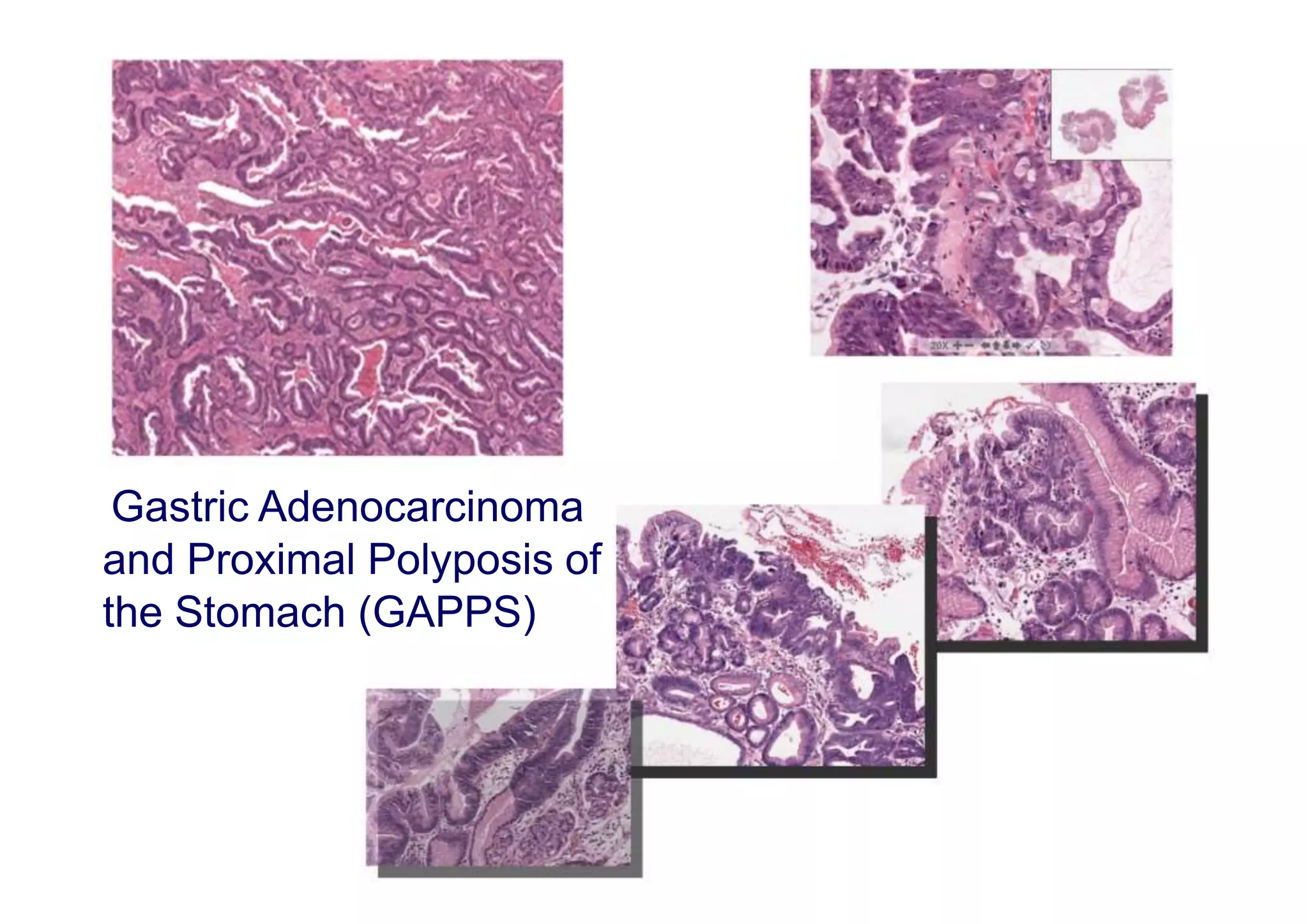 Gastric polyps | PPTX