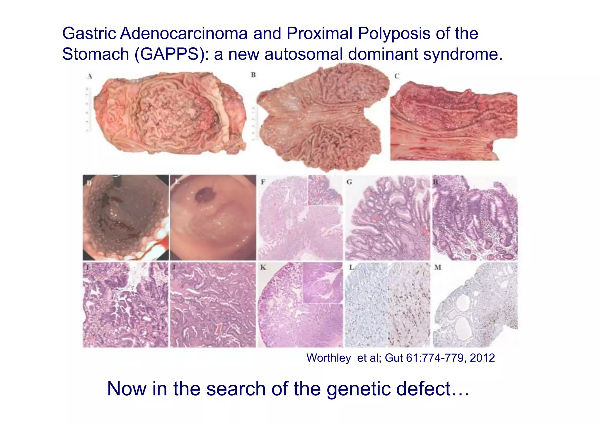 Gastric polyps | PPTX