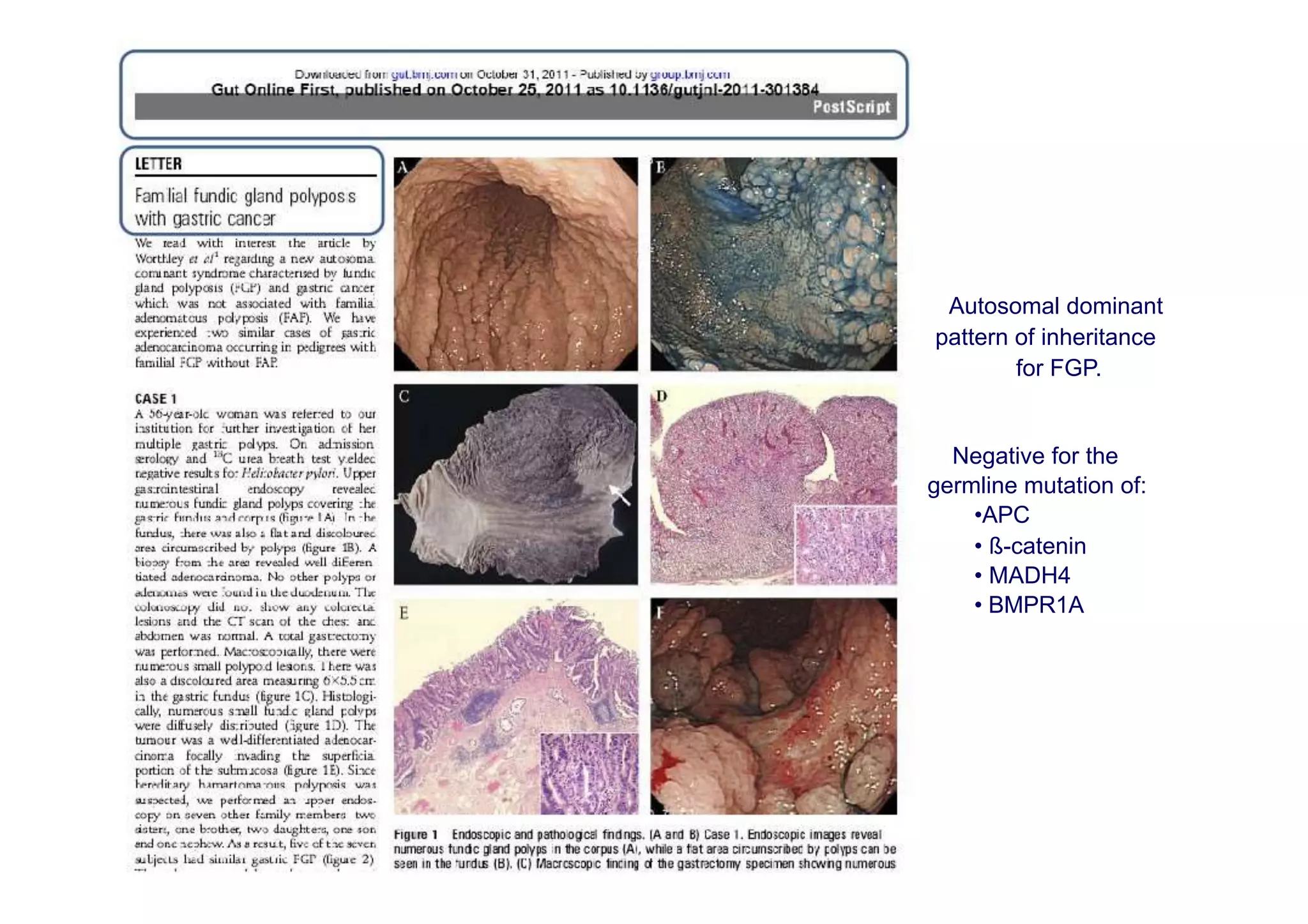 Gastric polyps | PPTX
